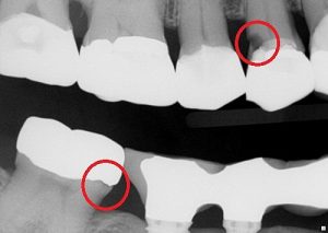 Do I Really Need a Dental Crown? | Cranford Dental