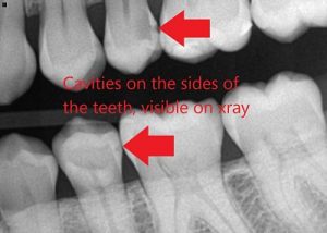 Do I Really Have a Cavity? | Cranford Dental