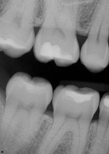 Do I Really Need Scaling & Root Planing? | Cranford Dental