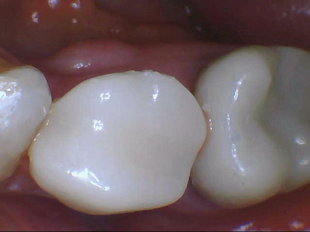 Should I Get a One Day Crown? | Cranford Dental