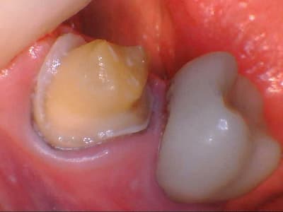 Should I Get a One Day Crown? | Cranford Dental