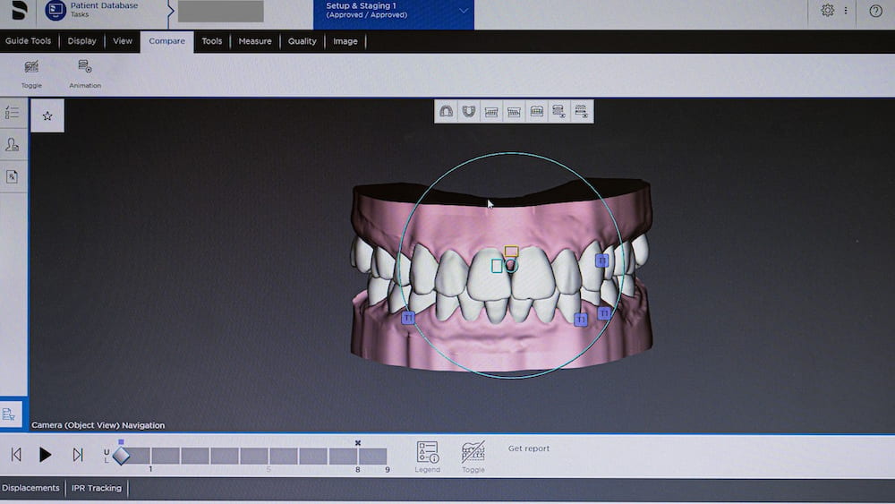Aligners, Braces [Orthodontics] Rock Hill, SC | Cranford Dental