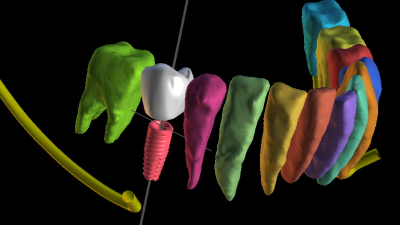 Placing Dental Implants [Technology] | Cranford Dental